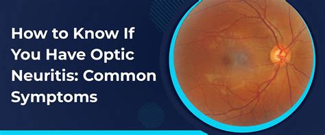 Optic Neuritis