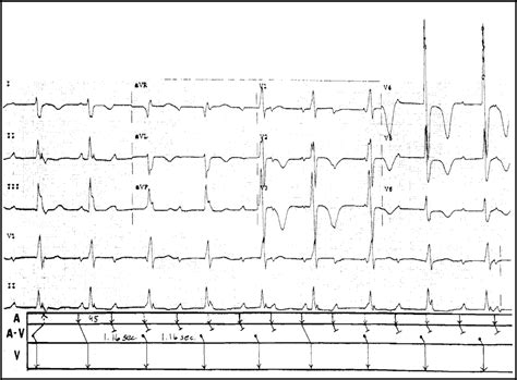 High Grade Av Block Manual Of Medicine