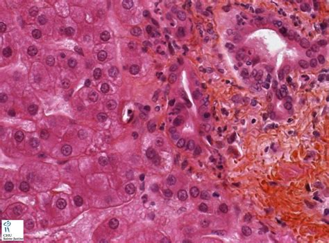 Cholangitis Human Pathology