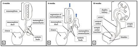 Ectopic Ureter