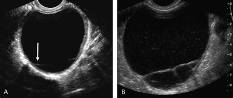 Serous Cystadenocarcinoma Ultrasound