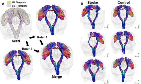 Figure 2 From Force Oscillations Underlying Precision Grip In Humans With Lesioned Corticospinal