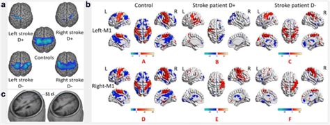 Cortical Reorganization Post Stroke A Cortical Activation In The Beta Download Scientific