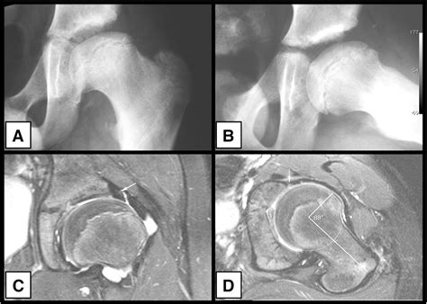 Figure 3 From Mri Abnormalities Of The Acetabular Labrum And Articular Cartilage Are Common In