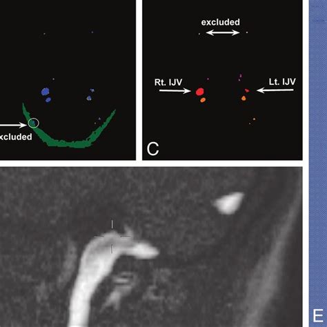 Example Of Vein Detection And Mapping Algorithms In 1 Participant The Download Scientific