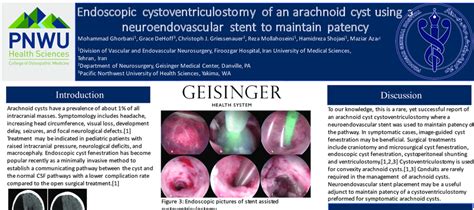 Ct Scan Of The Head Showing Large Right Convexity Arachnoid Cyst With
