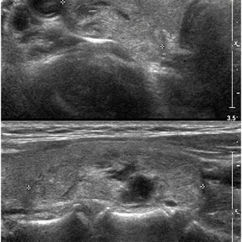 Tirads Classification Algorithm 13 Download Scientific Diagram