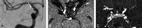 Complete Embolization Of A Right Ica Aneurysm Arrow On Dsa Follow Up Download Scientific