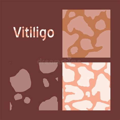 Vitiligo Pattern Stock Illustrations 150 Vitiligo Pattern Stock
