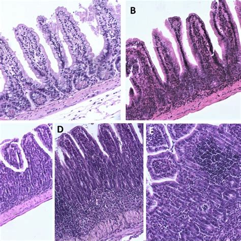 Aphthous Ulcers On Terminal Ileum Download Scientific Diagram