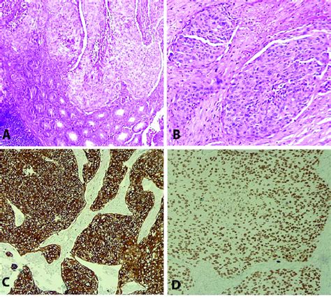A B The Appendix Wall Was Compromised By Cancerous Cells Characterized