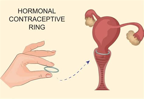 Vaginal Ring Birth Control Method Usage Guidelines Pros And Cons
