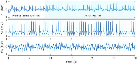 examples of false positive errors in afib detection s1 is a 30 s ecg