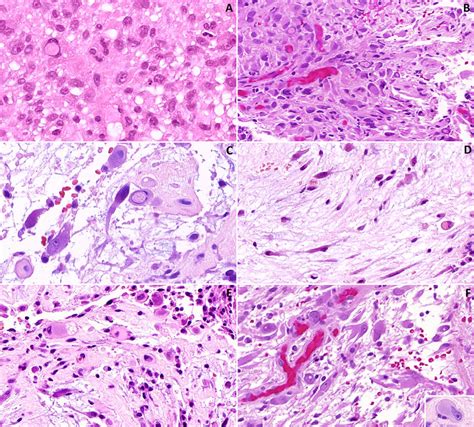 Atypical Tumor Cells Present In The Tumors Some Atypical Cells