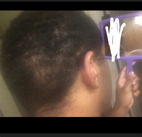 This Is The Back Of My Hair It Grows So Much Slower Than The Rest Of