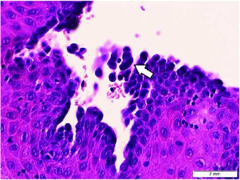 Punch Biopsy Of The Oral Mucosa Suprabasal Acantholysis Download Scientific Diagram