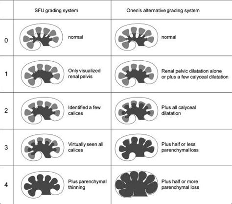 Hidronefrosis Grade Ultrasonido