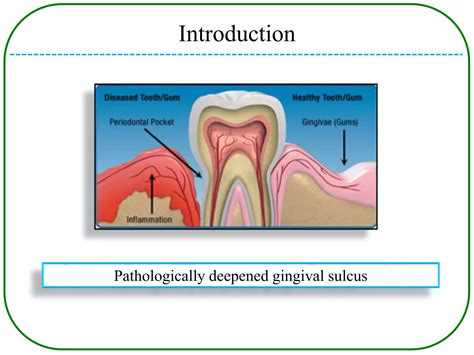 Periodontal Pockets Pptx