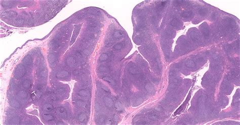 Tonsil Normal Histology Nus Pathweb Nus Pathweb
