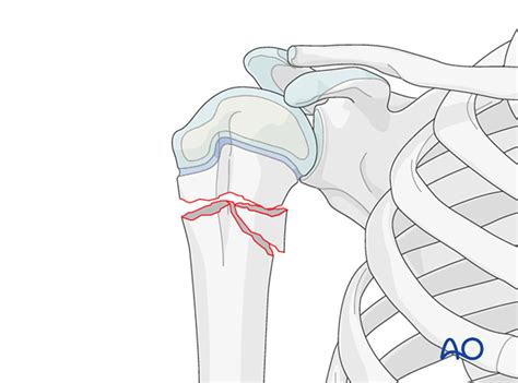 Multifragmentary Complete Metaphyseal Fracture