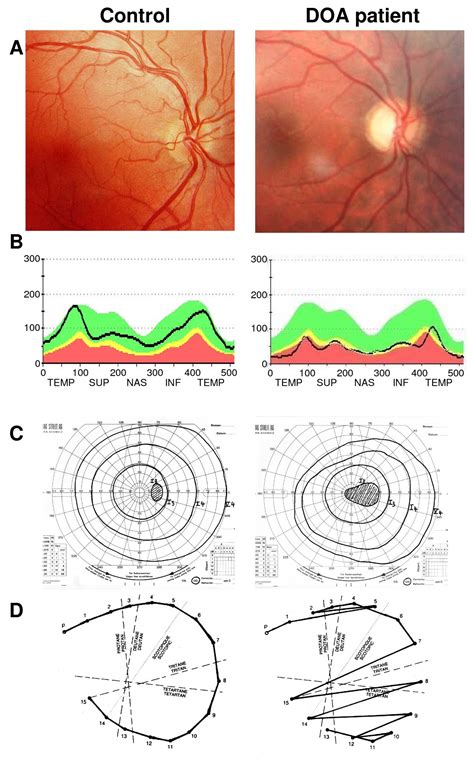 Optic Atrophy 1 At Gabriel Chubb Blog