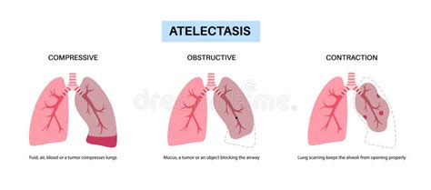Atelectasis Medical Poster Stock Vector Illustration Of Alveolar 276060411