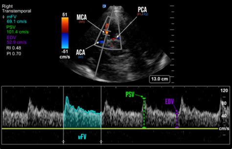 Transcranial Doppler In The Emergency Department A Clinical