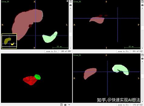 基于3d分割实现自动判断脂肪肝和严重程度 知乎