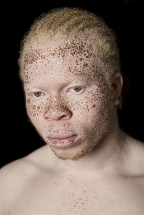 Pin By Emily Haslam On [faces] Albino Person Albino Human Freckles