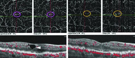 Type 3 Neovascularization On The Left En Face Oct A Slabs Show The Download Scientific