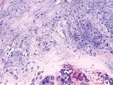 Osteochondroma And Multiple Hereditary Exostosis Pathology Orthobullets