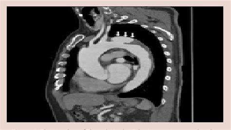 Figure 1 From Enlarged Ulcer Like Projection And Acute Arterial Embolism In The Lower Limbs Of A