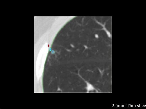 Ppt Cad Performance Analysis For Pulmonary Nodule Detection Comparison Of Thick And Thin