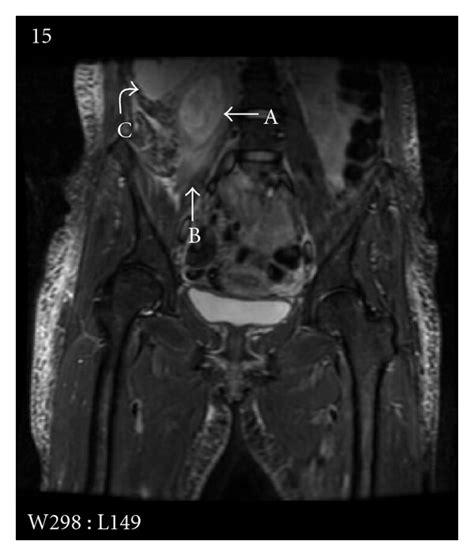 Psoas Abscess Formation In Suboptimally Controlled Diabetes Mellitus Lansdown 2011 Case