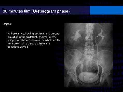 Intravenous Urography Ivu