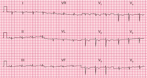 Ecg Case 147 Digoxin Effect With Possible Digoxin Toxicity Manual Of