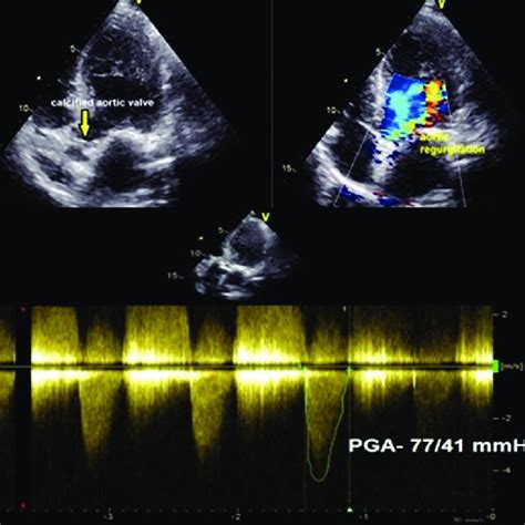 Transthoracic Echocardiography Suprasternal View Coarctation Of Aortae Download Scientific