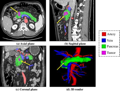 Automated Peripancreatic Vessel Segmentation And Labeling Based On Iterative Trunk Growth And
