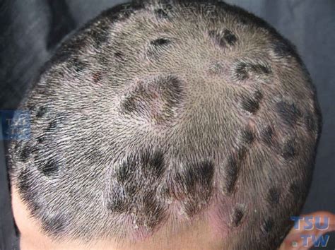 寻常型银屑病Psoriasis Vulgaris的症状表现 皮肤病学 天山医学院