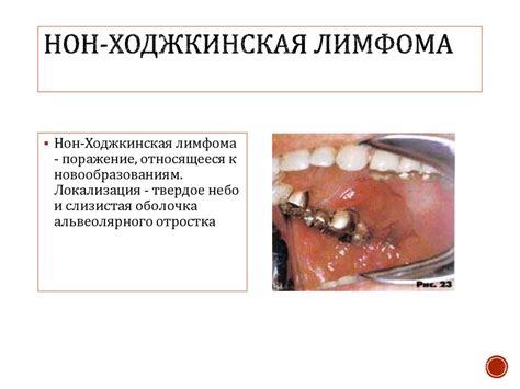 Вирус иммунодефицита человека ВИЧ презентация онлайн