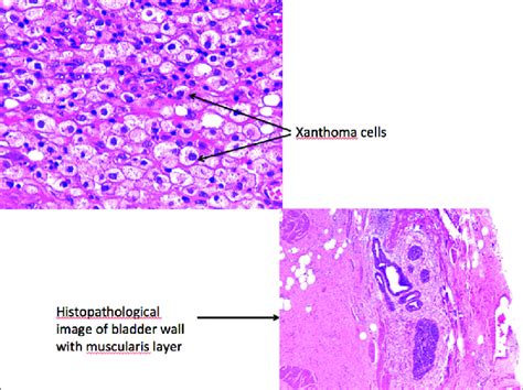 Xanthoma Cells Histological Findings Of An Achilles Xanthoma Showing