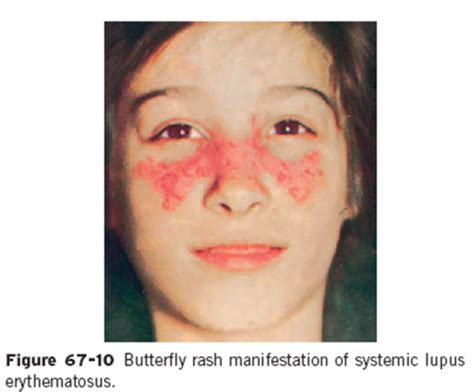 Connective Tissue Disorders Lupus And Scleroderma Flashcards Quizlet