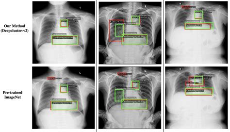 Qualitative Results On Detecting Abnormal Nodules In The Vindr Cxr Download Scientific Diagram