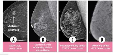 [pdf] Breast Density Notification Semantic Scholar