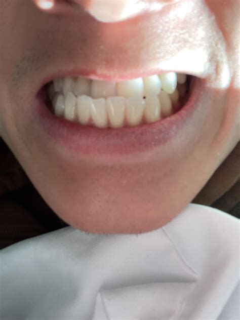 21m With Class Three Underbite That Had Braces Previously I Want To Fix It But Scared R