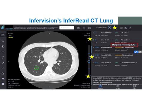 Fda Clears Infervisions Ai Powered Lung Ct Reader 2020 07 10 Bioworld
