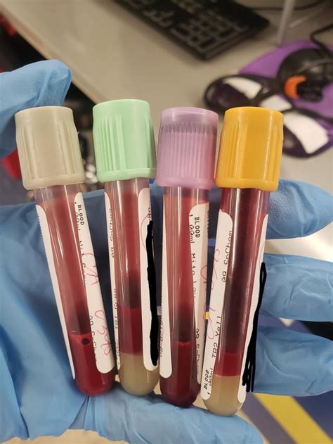 Er Wanted A Tb Quantiferon R Medlabprofessionals