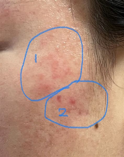 여드름 약국템 지식in