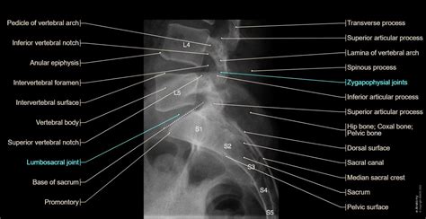 Lateral Sacrum Anatomy Sacral Lateral Branch Nerve Block