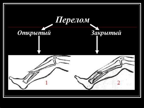 Виды переломов презентация онлайн